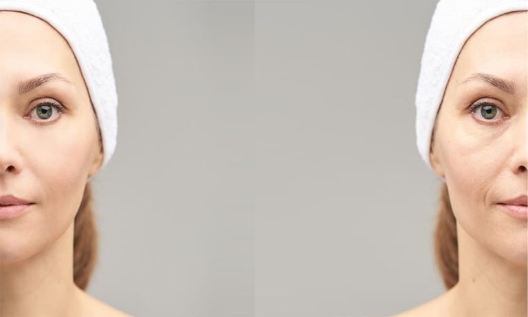 Can Fillers Help With Under Eye Bags Diaminy Aesthetics